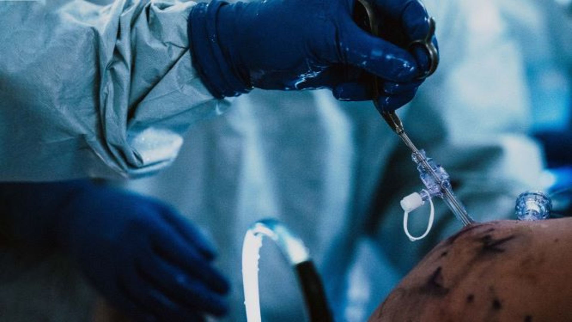 Left Shoulder Arthroscopic Anterior Labral Repair