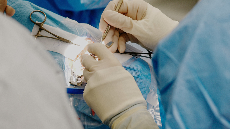 Left Baerveldt 350 Glaucoma Drainage Device Implantation with Cornea ...