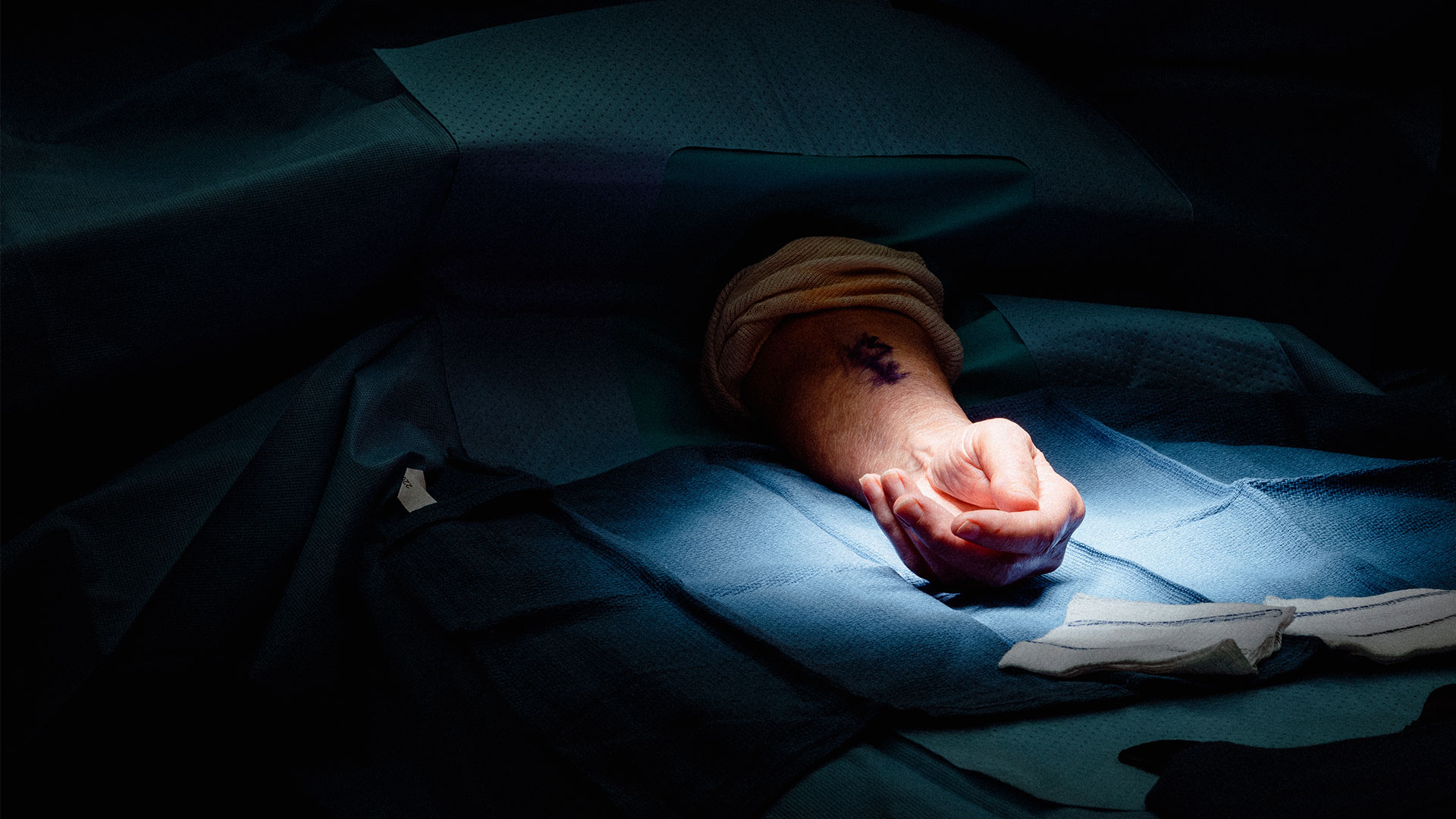 Left Thumb Trapeziectomy and Tightrope Suspension Arthroplasty