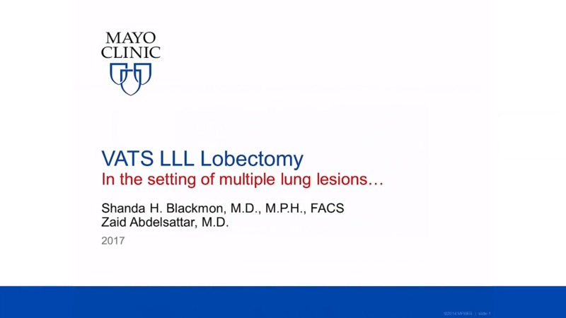 Multifocal Lung Cancer Discussion and Case Presentation