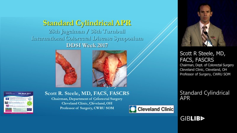 Rectal Cancer: Standard Cylindrical APR
