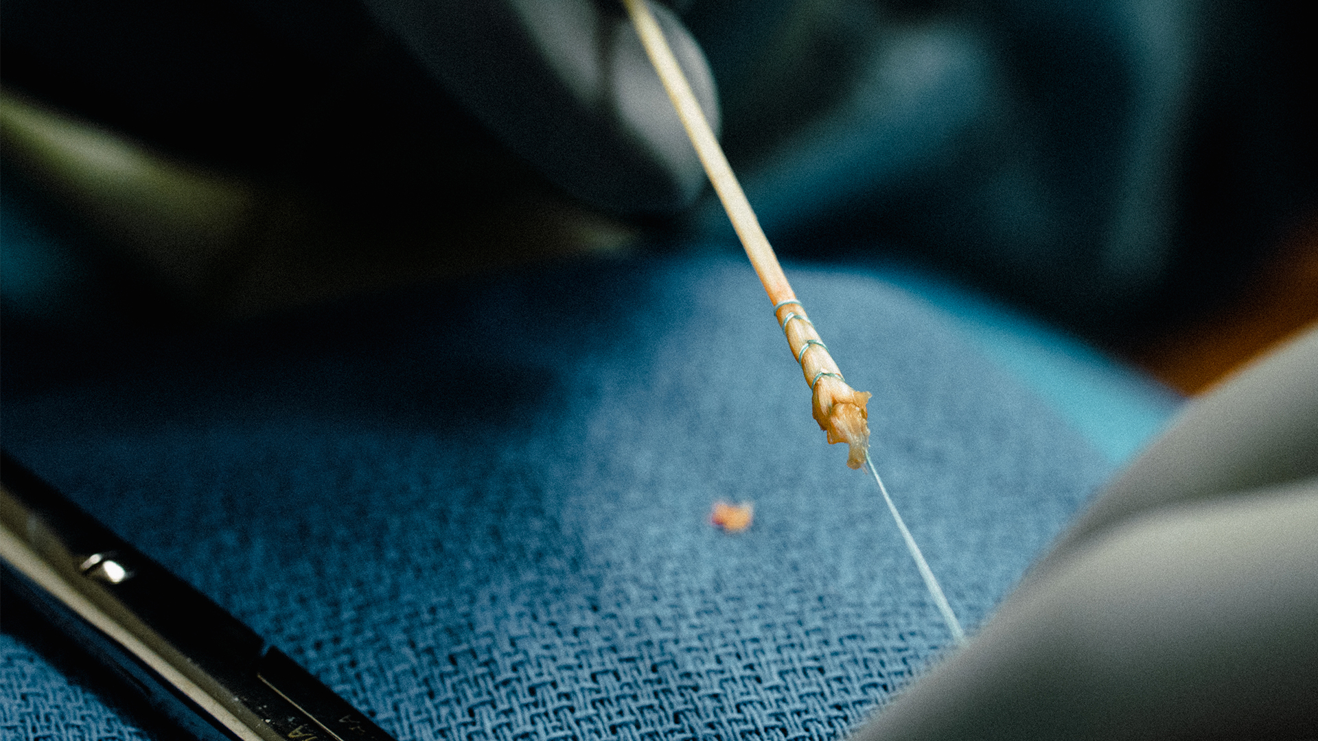 Scapholunate Ligament Reconstruction with 360 Degree Tenodesis and ...