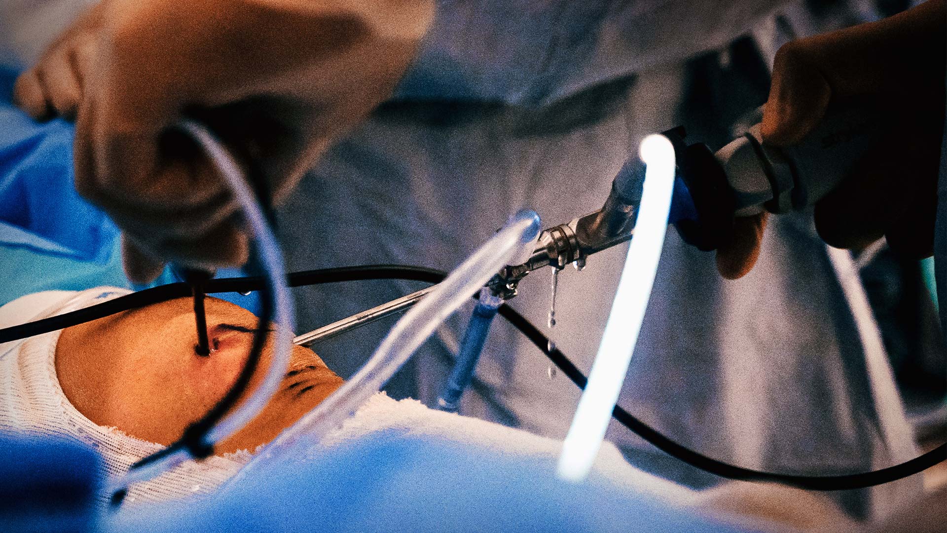 Partial Medial and Lateral Meniscectomies and Shaving Chondroplasty