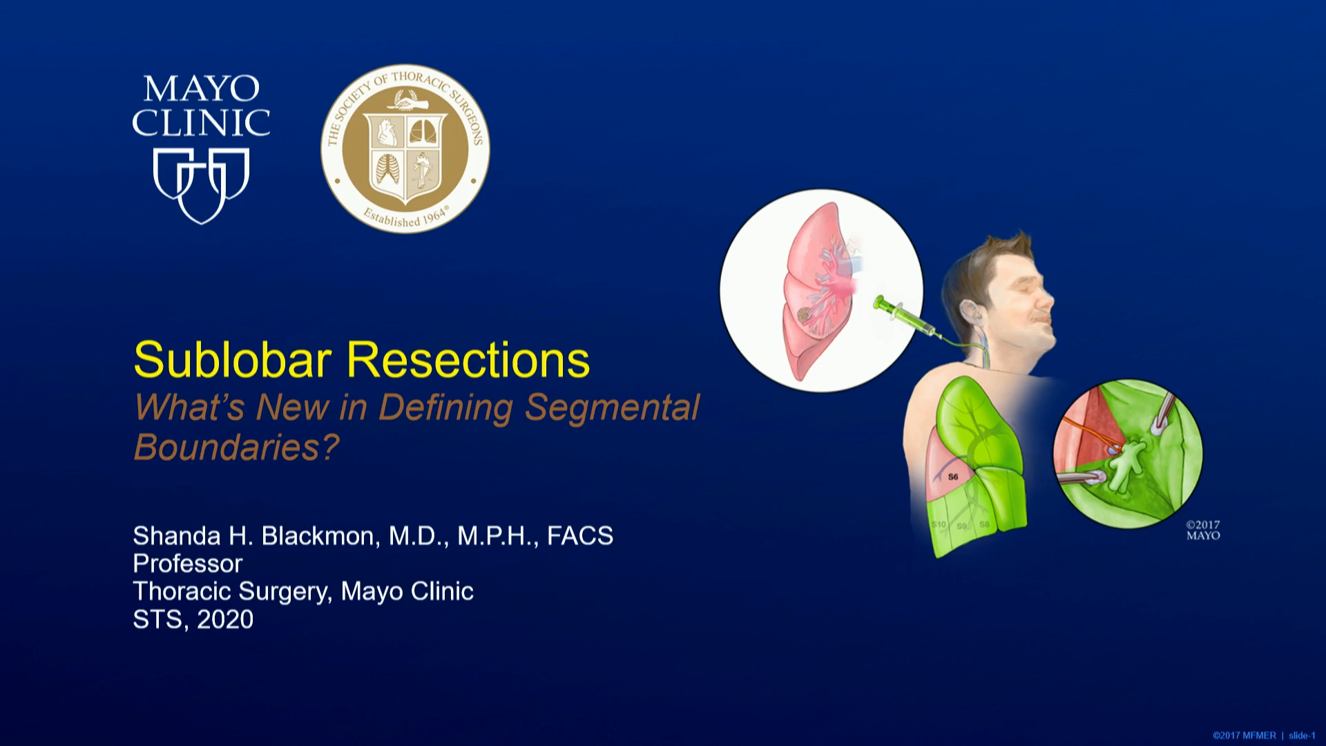 Sublobar Resection Whats New In Defining Segment Boundaries