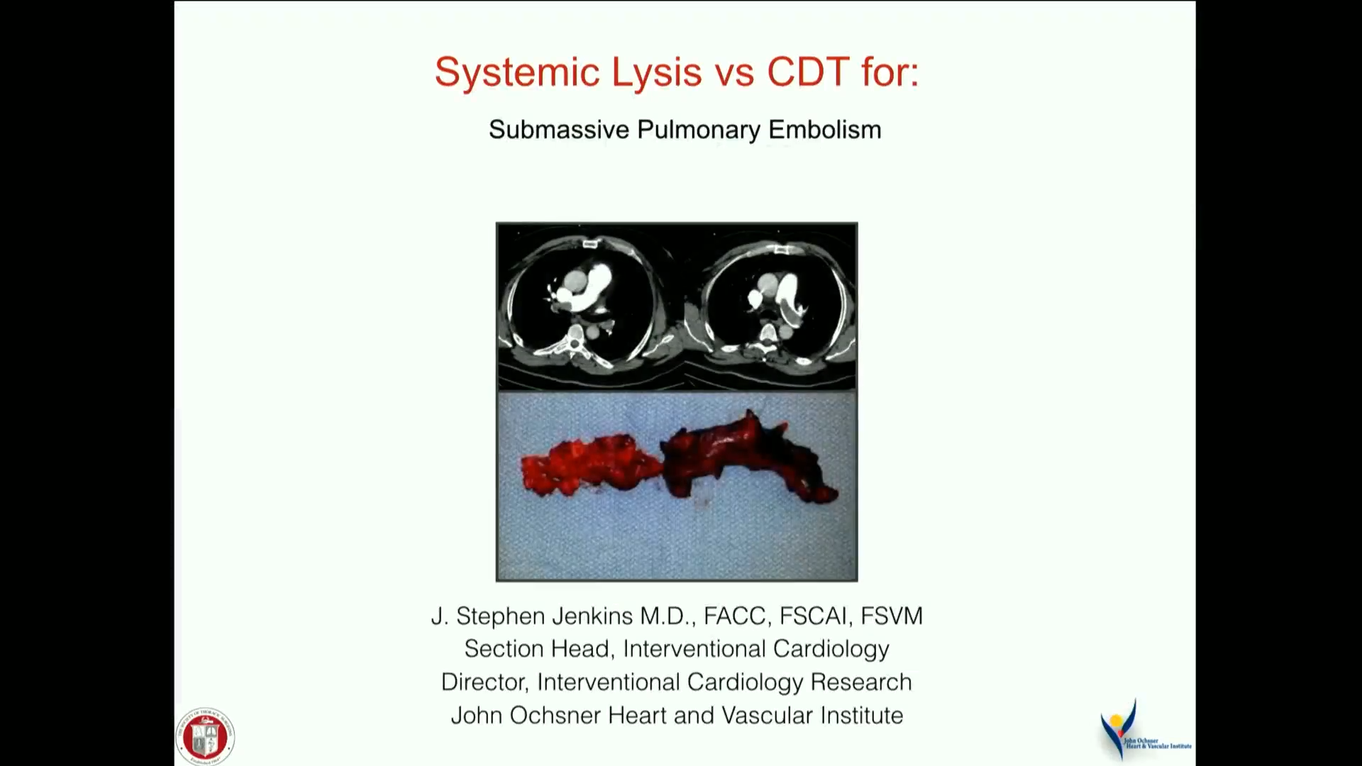 Thrombolytic Therapy versus Catheter-Directed Therapy in Submassive PE